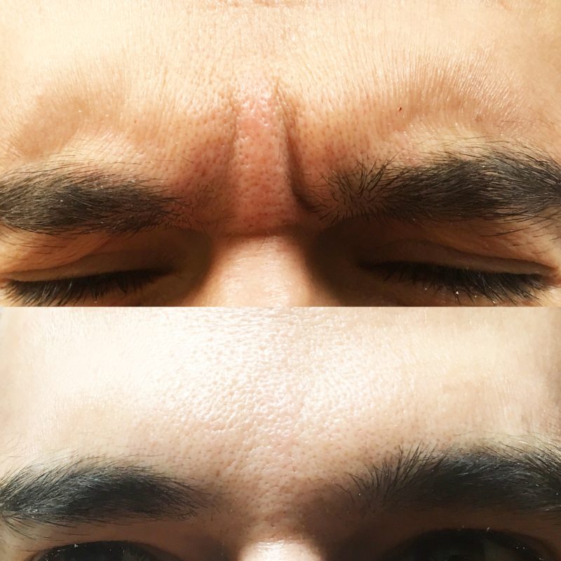 Wrinkle Reducers Vs. Dermal Fillers - Affiliated Dermatology