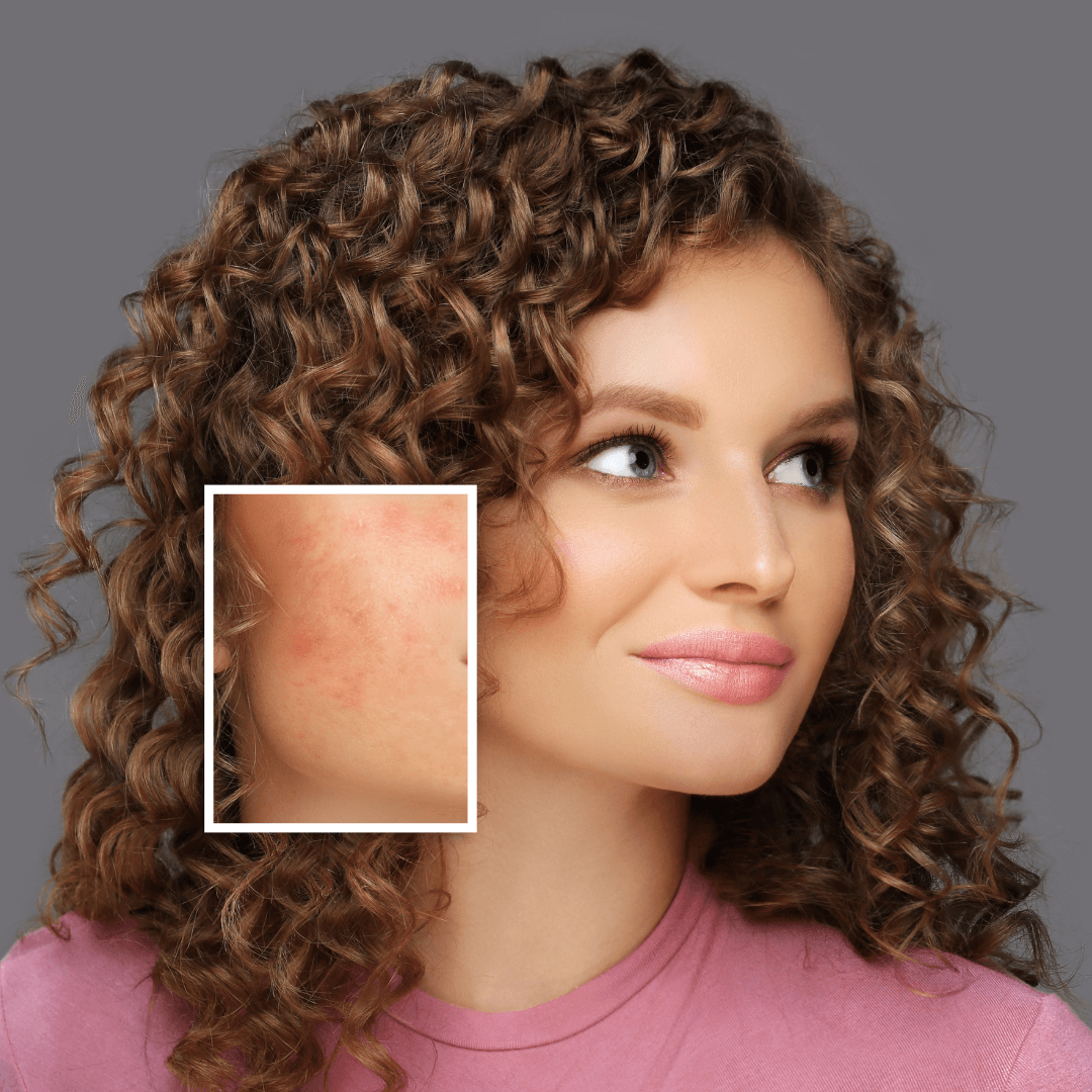 Restylane Filler Treatments in Phoenix, AZ | Dermal Fillers ...