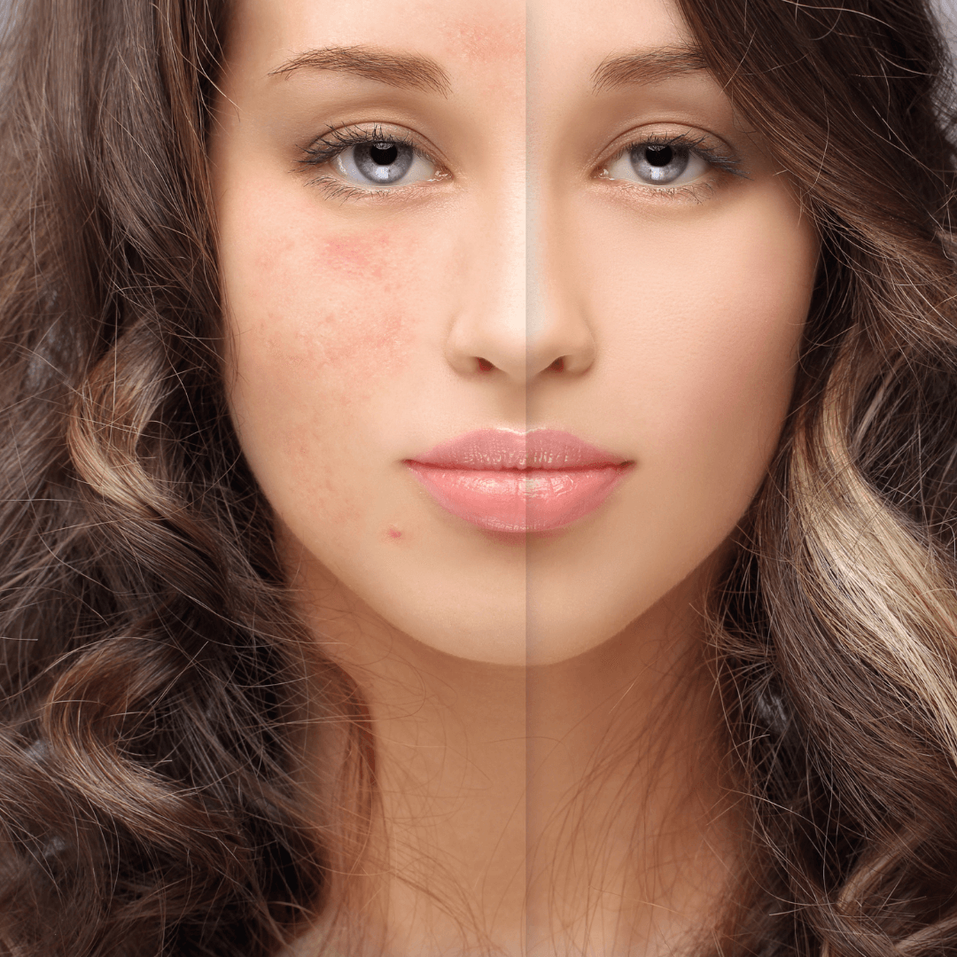 Restylane Filler Treatments in Phoenix, AZ | Dermal Fillers ...