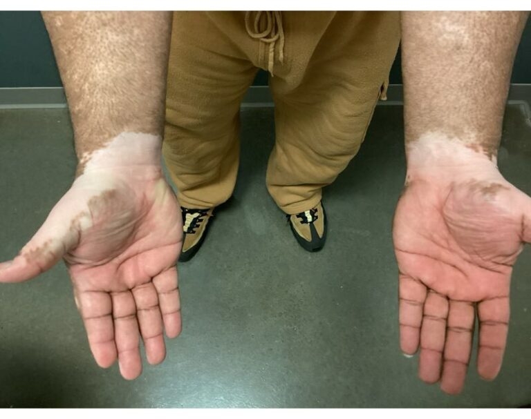 Vitiligo Treatment in Phoenix, AZ | Affiliated Dermatology